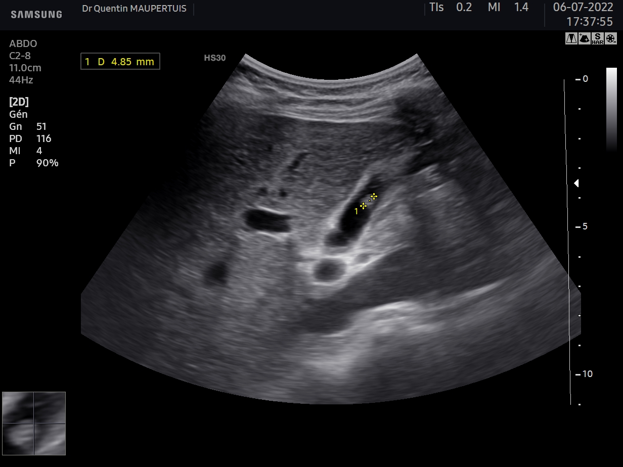 Échographie de la vésicule et des voies biliaires. – Échoclic