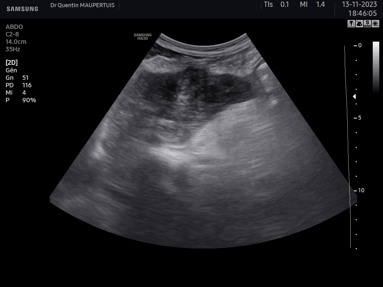 L’échographie hépatique partie 2 : Anomalies hépatiques – Échoclic