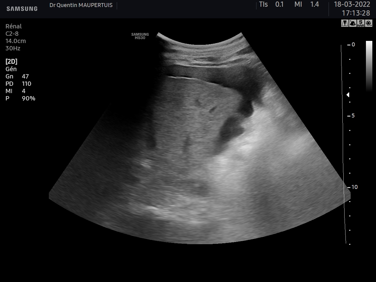 L’échographie hépatique partie 2 : Anomalies hépatiques – Échoclic