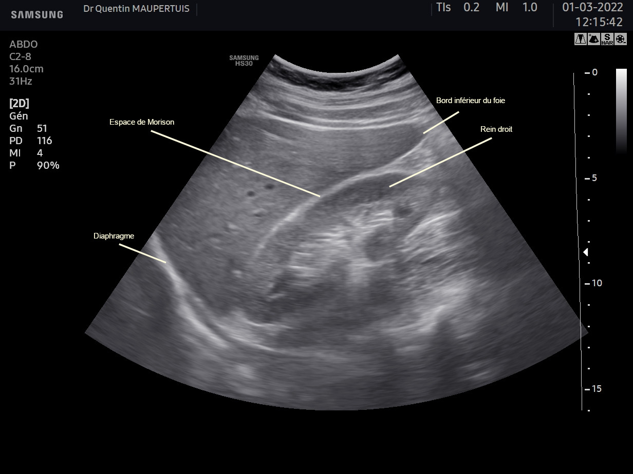 L’échographie hépatique partie 1 : Méthode. – Échoclic