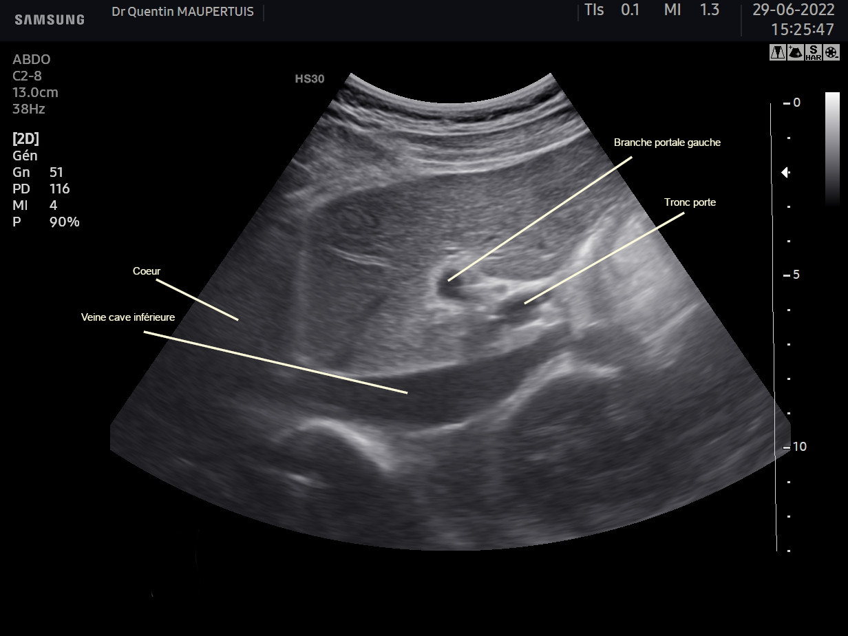 L’échographie hépatique partie 1 : Méthode. – Échoclic