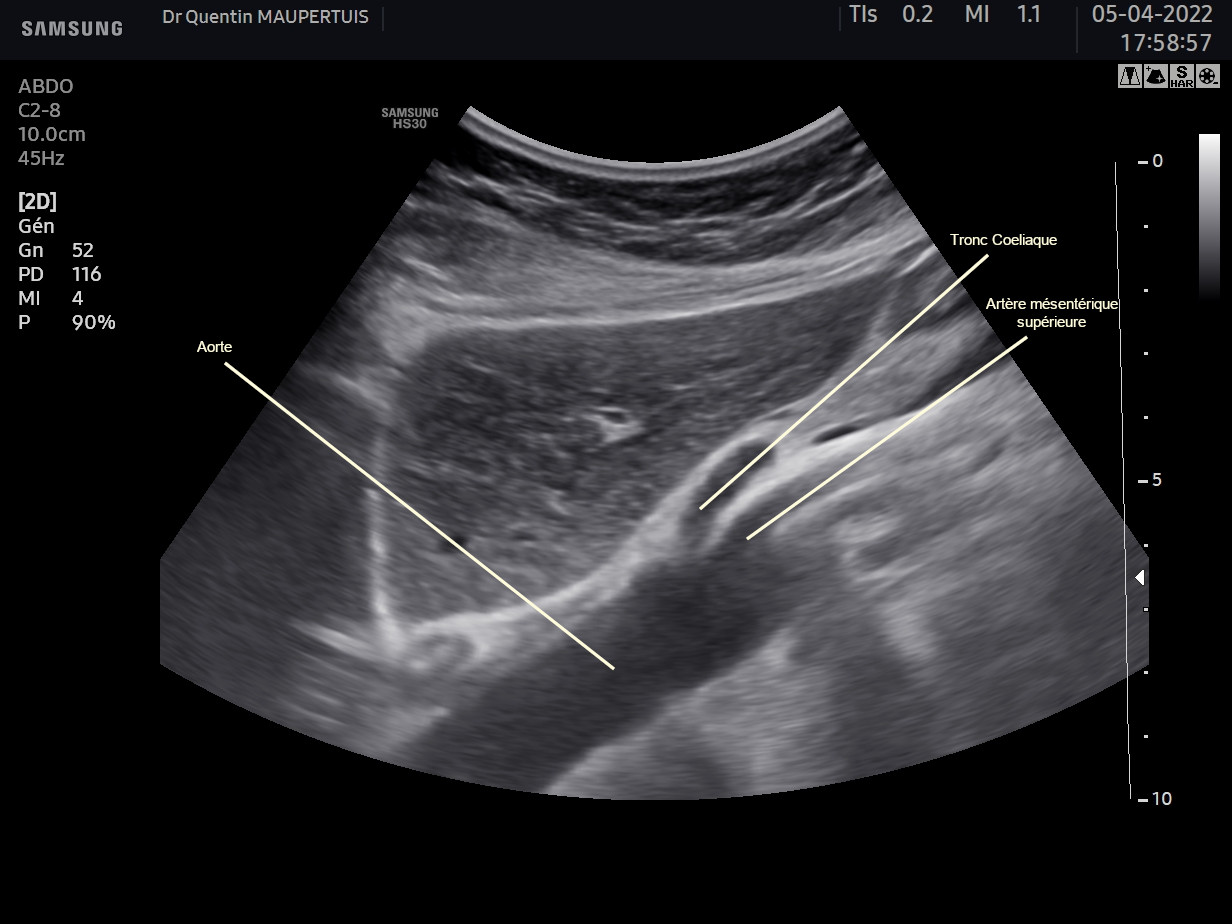 L’échographie hépatique partie 1 : Méthode. – Échoclic