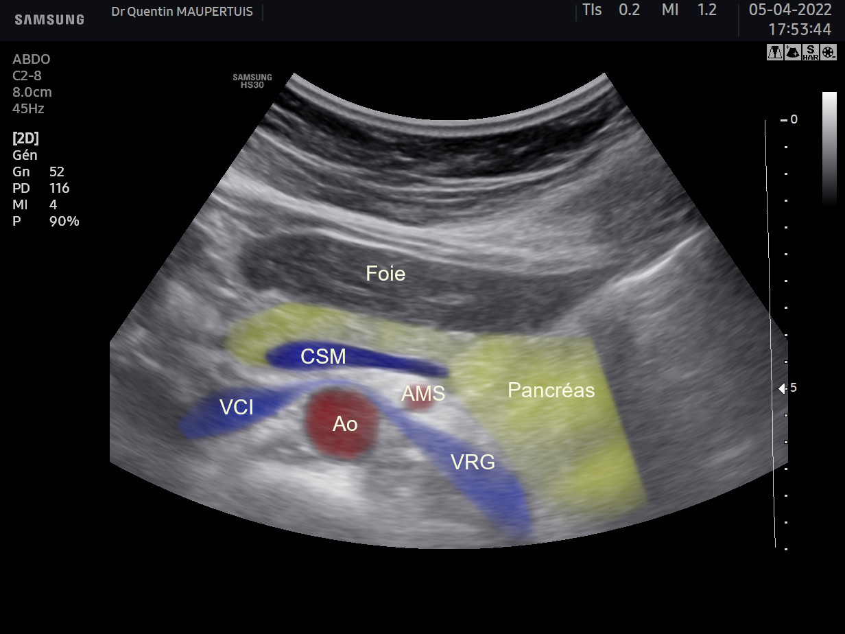 Echographie du pancréas. – Échoclic